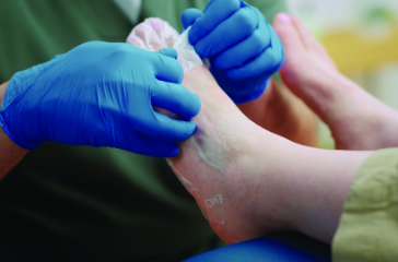 DPN - Treatment and Ongoing Use | QUTENZA HCP